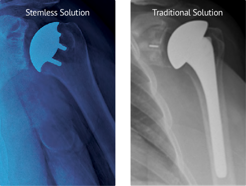 Shoulder Treatment in Muskegon & Grand Haven, MI | Orthopaedic ...