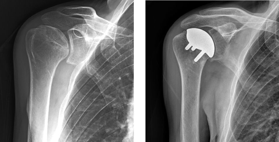 Shoulder Treatment in Muskegon & Grand Haven, MI | Orthopaedic ...