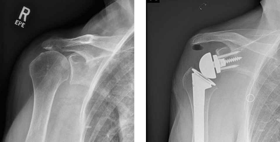 Shoulder Treatment in Muskegon & Grand Haven, MI | Orthopaedic ...